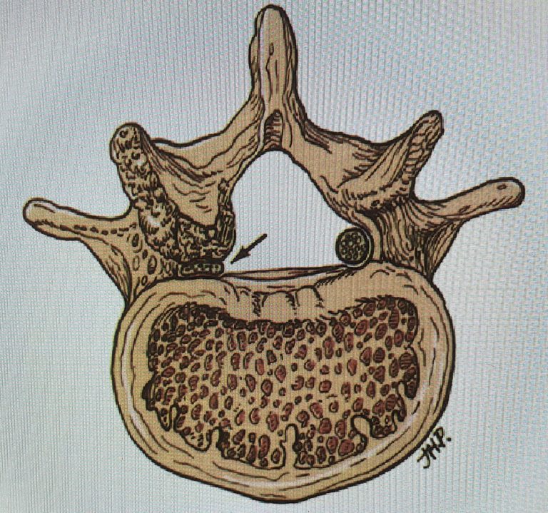 Lateral Recess Stenosis | NSPC Brain & Spine Surgery